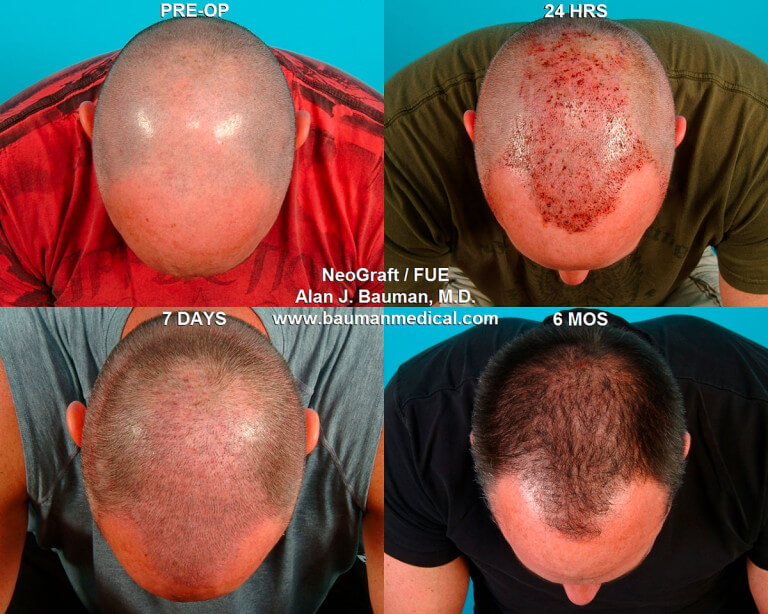 Best NeoGraft FUE Treatment in Florida | Bauman Medical Best NeoGraft FUE Treatment in Florida | Bauman Medical