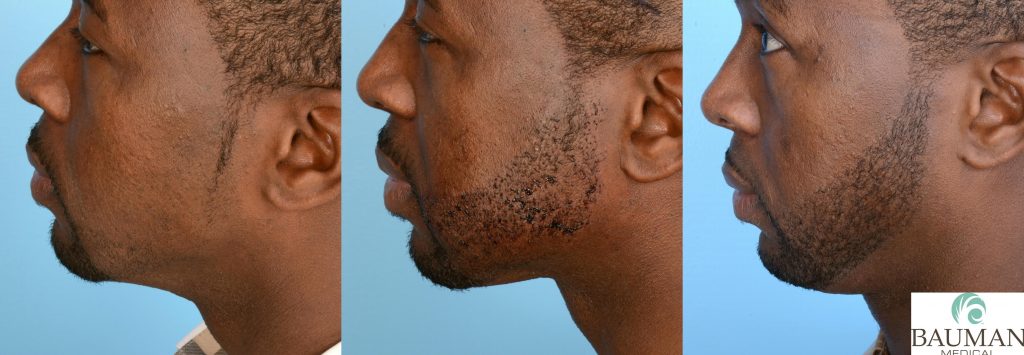 Beard & Mustache Transplantation Results · Bauman Medical