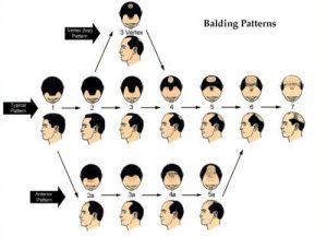 Male Pattern Baldness Explained - Bauman Medical